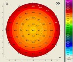 Calculation of Corneal Power - Oculus Pentacam | Blue River Medical, Inc.