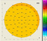 Calculation of Corneal Power - Oculus Pentacam | Blue River Medical, Inc.